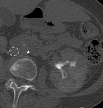 CT Urography-MH